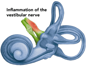 Vestibular Neuritis and Labyrinthitis | Wake Forest Baptist Health